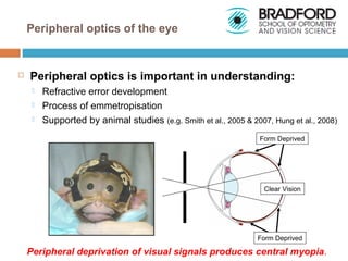 Peripheral refraction in myopia | PPT