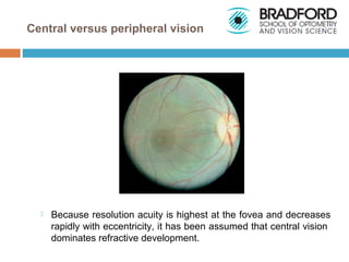 Peripheral refraction in myopia | PPT