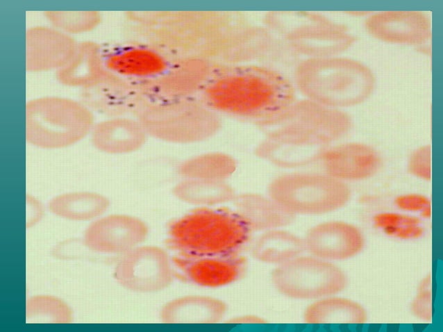 Peripheral smear | PPT | Blood Disorders | Diseases and Conditions