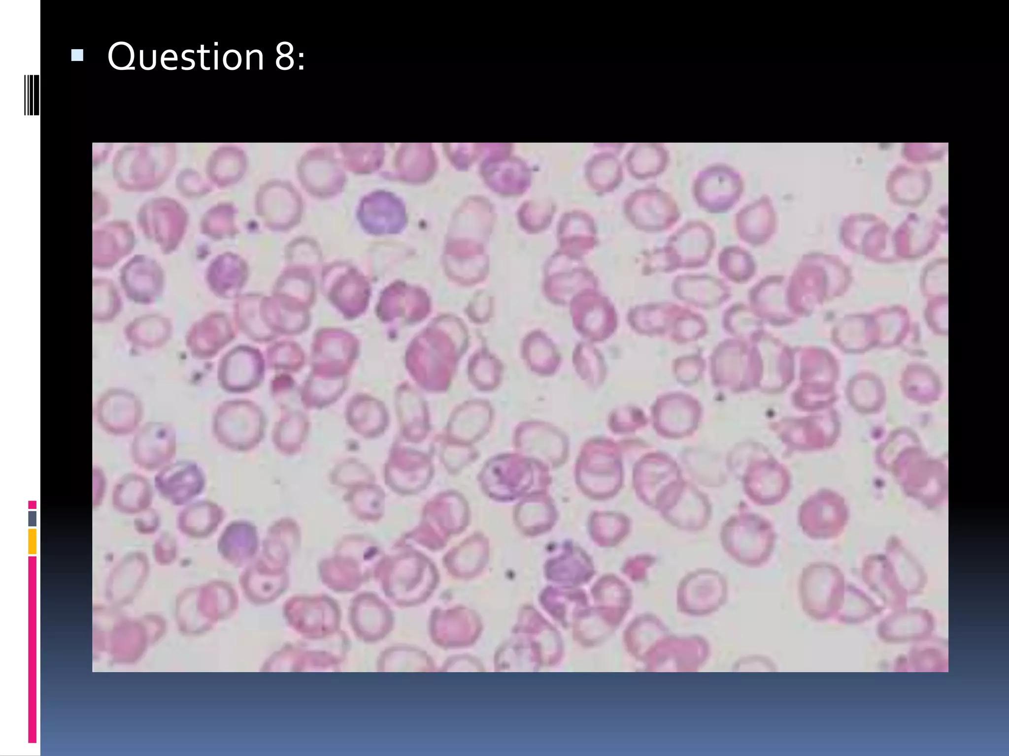 Peripheral smear..RBC disorders.. Dr.Padmesh | PPT | Free Download