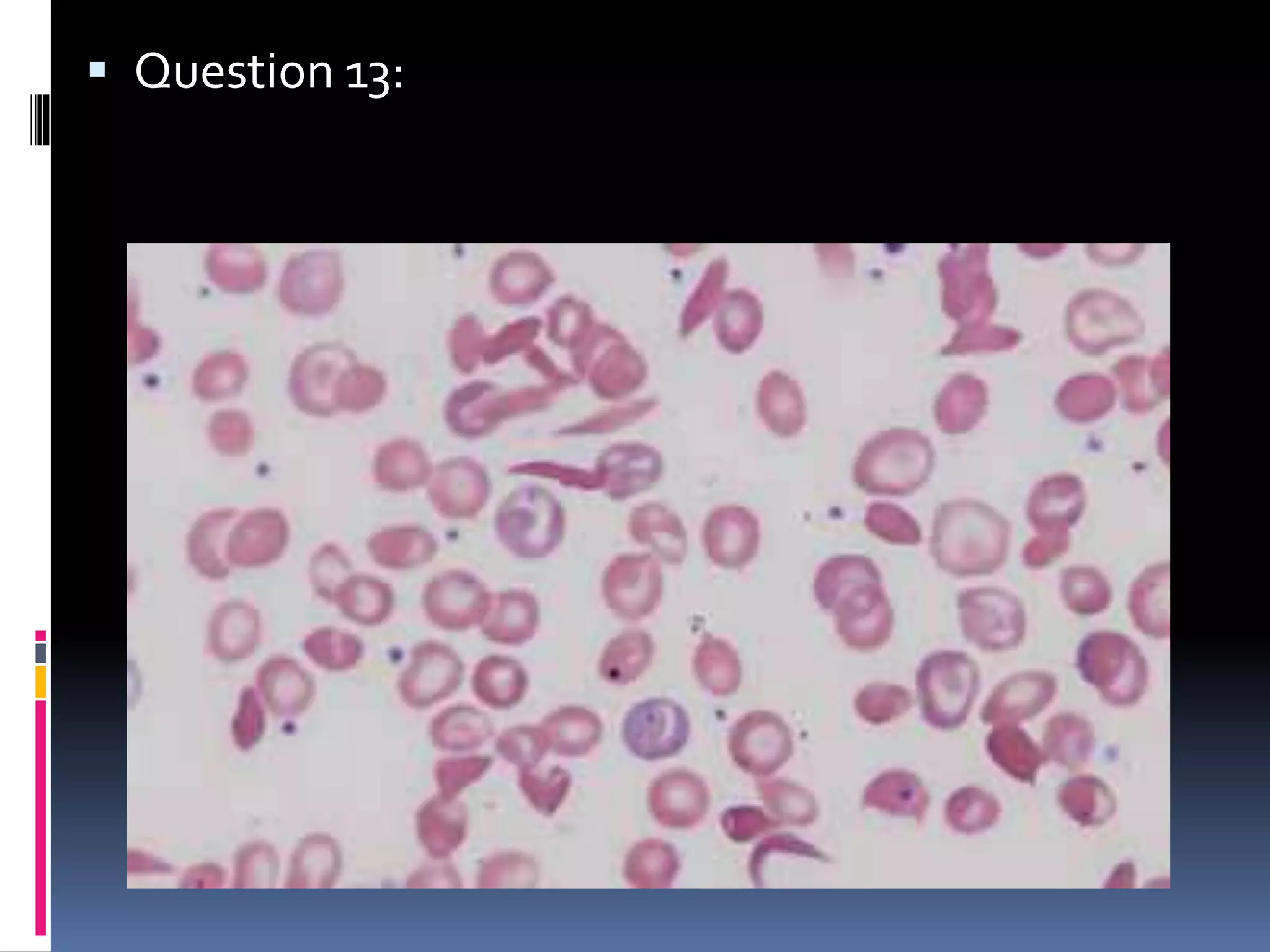 Peripheral smear..RBC disorders.. Dr.Padmesh | PPTX