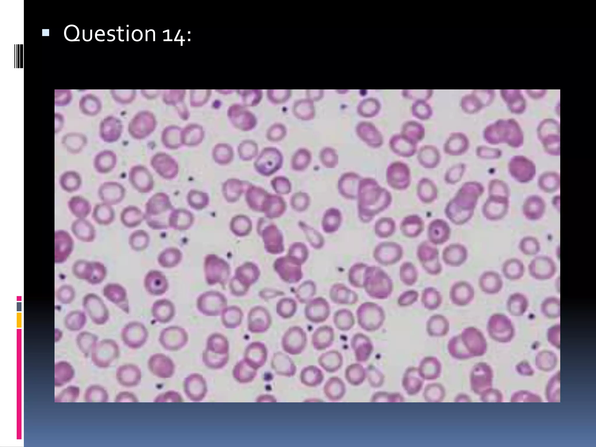 Peripheral smear..RBC disorders.. Dr.Padmesh | PPTX