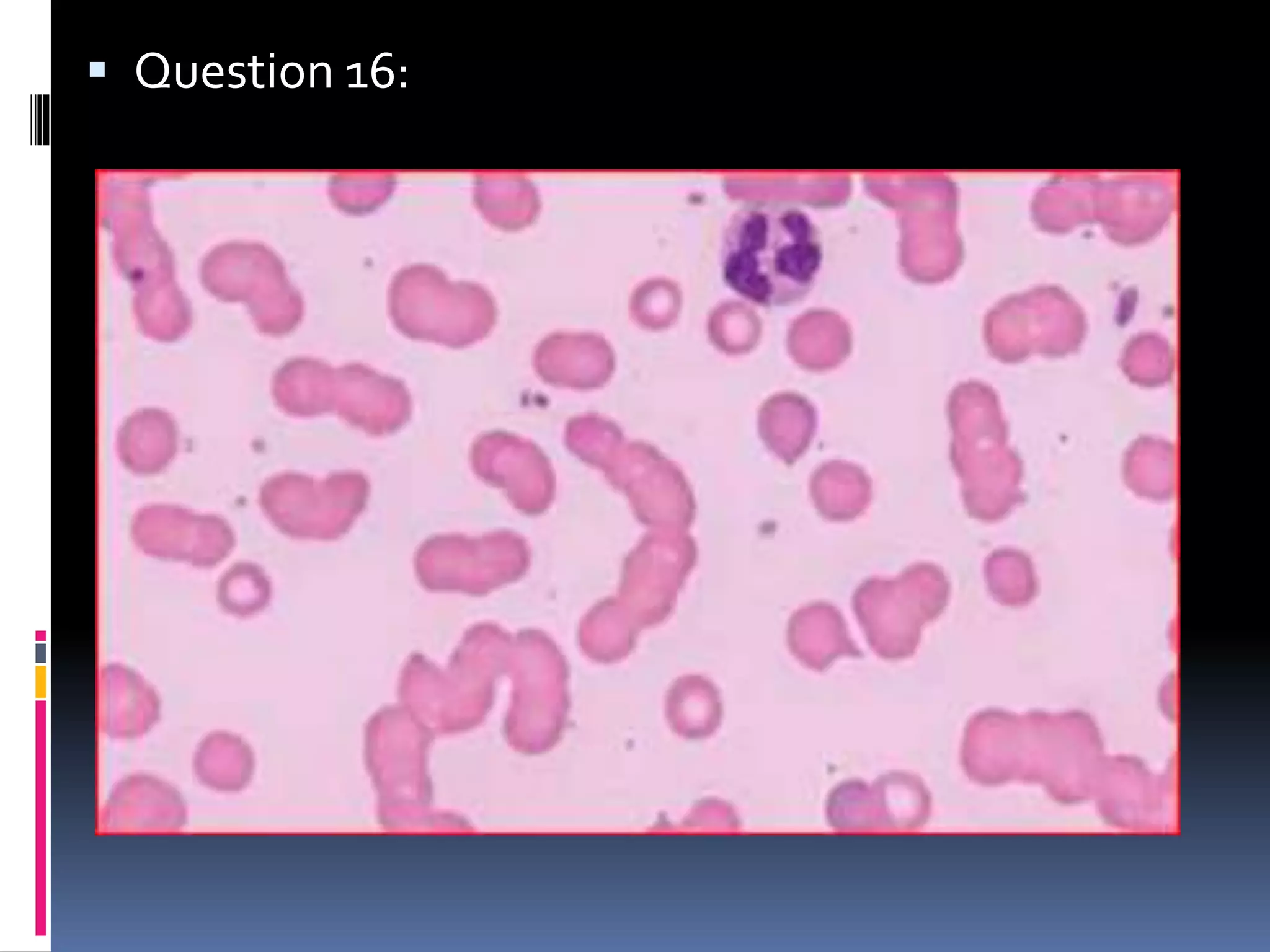 Peripheral smear..RBC disorders.. Dr.Padmesh | PPTX