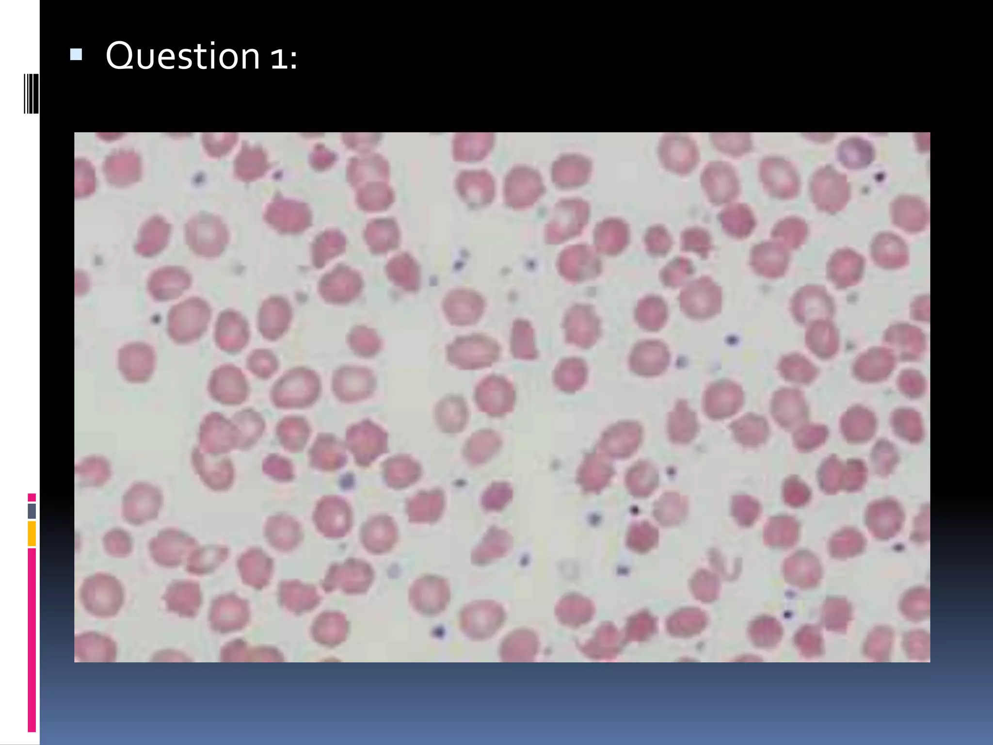 Peripheral smear..RBC disorders.. Dr.Padmesh | PPT | Free Download