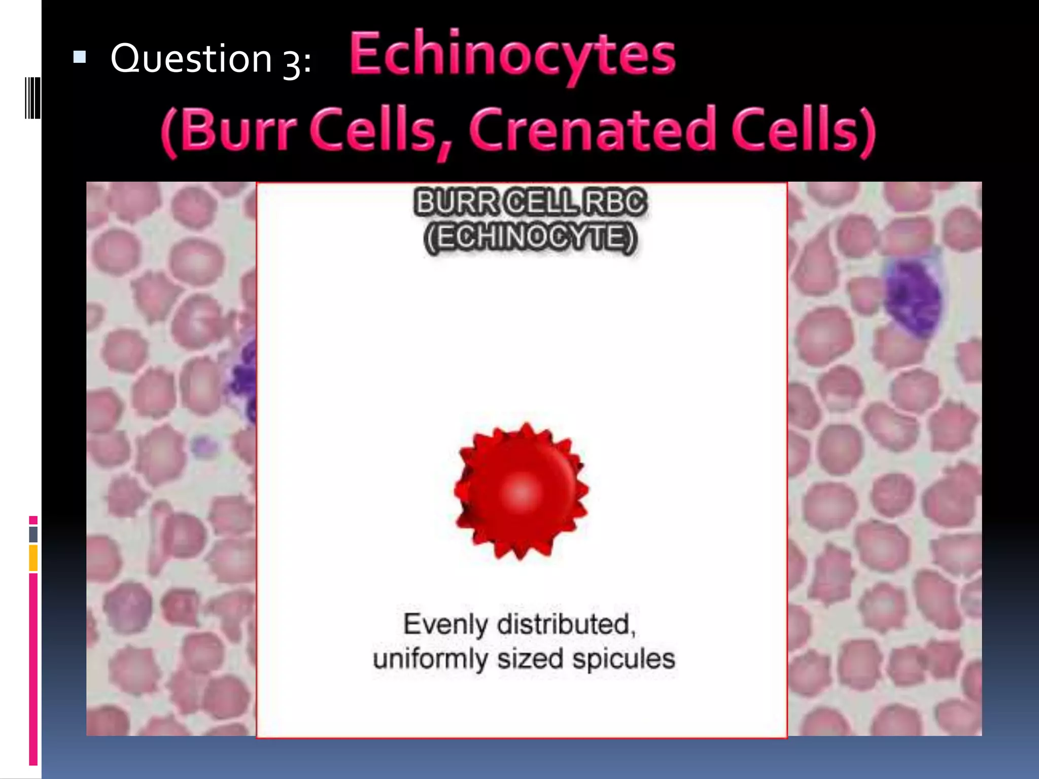 Peripheral smear..RBC disorders.. Dr.Padmesh | PPTX