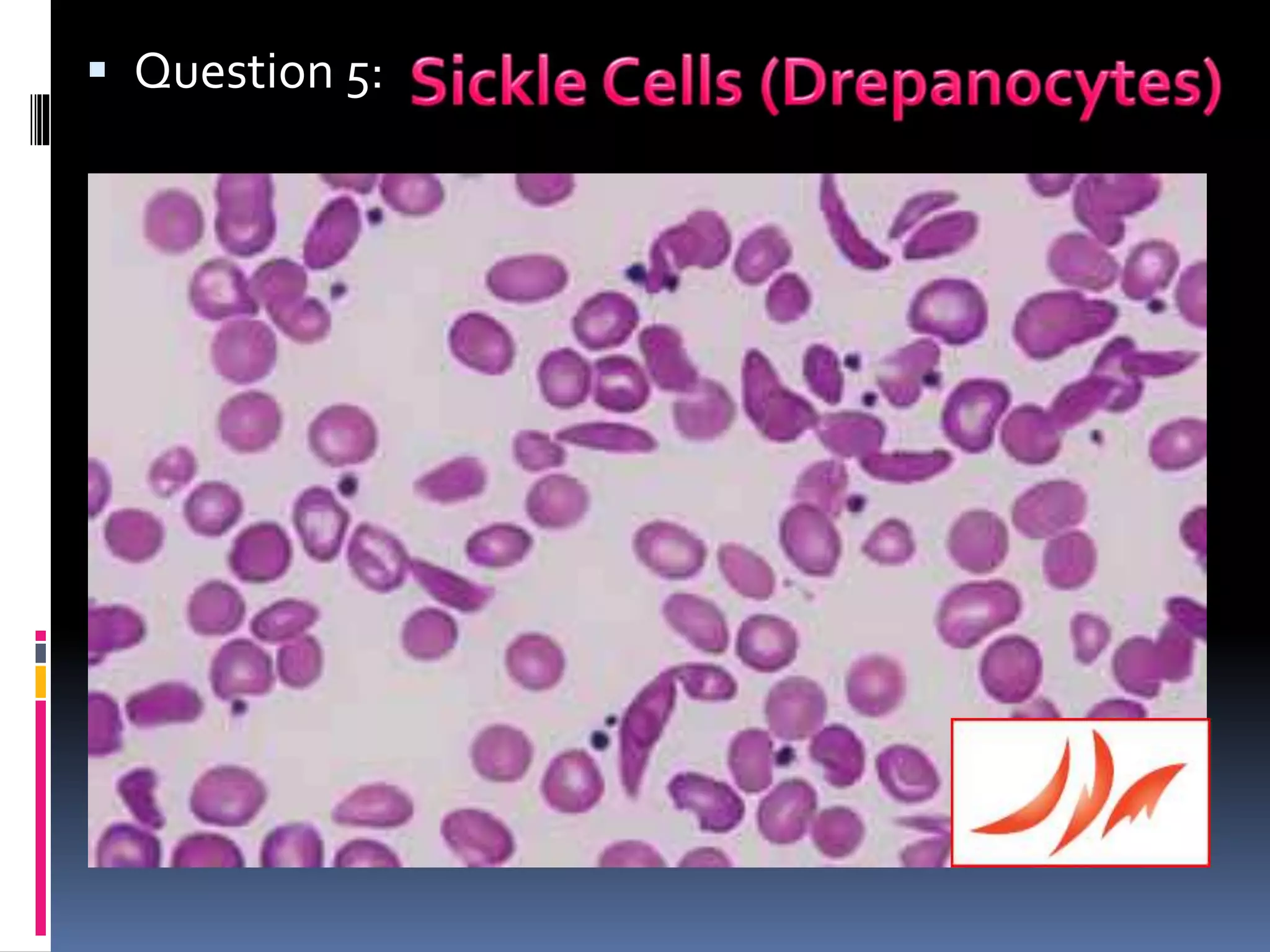 Peripheral smear..RBC disorders.. Dr.Padmesh | PPTX