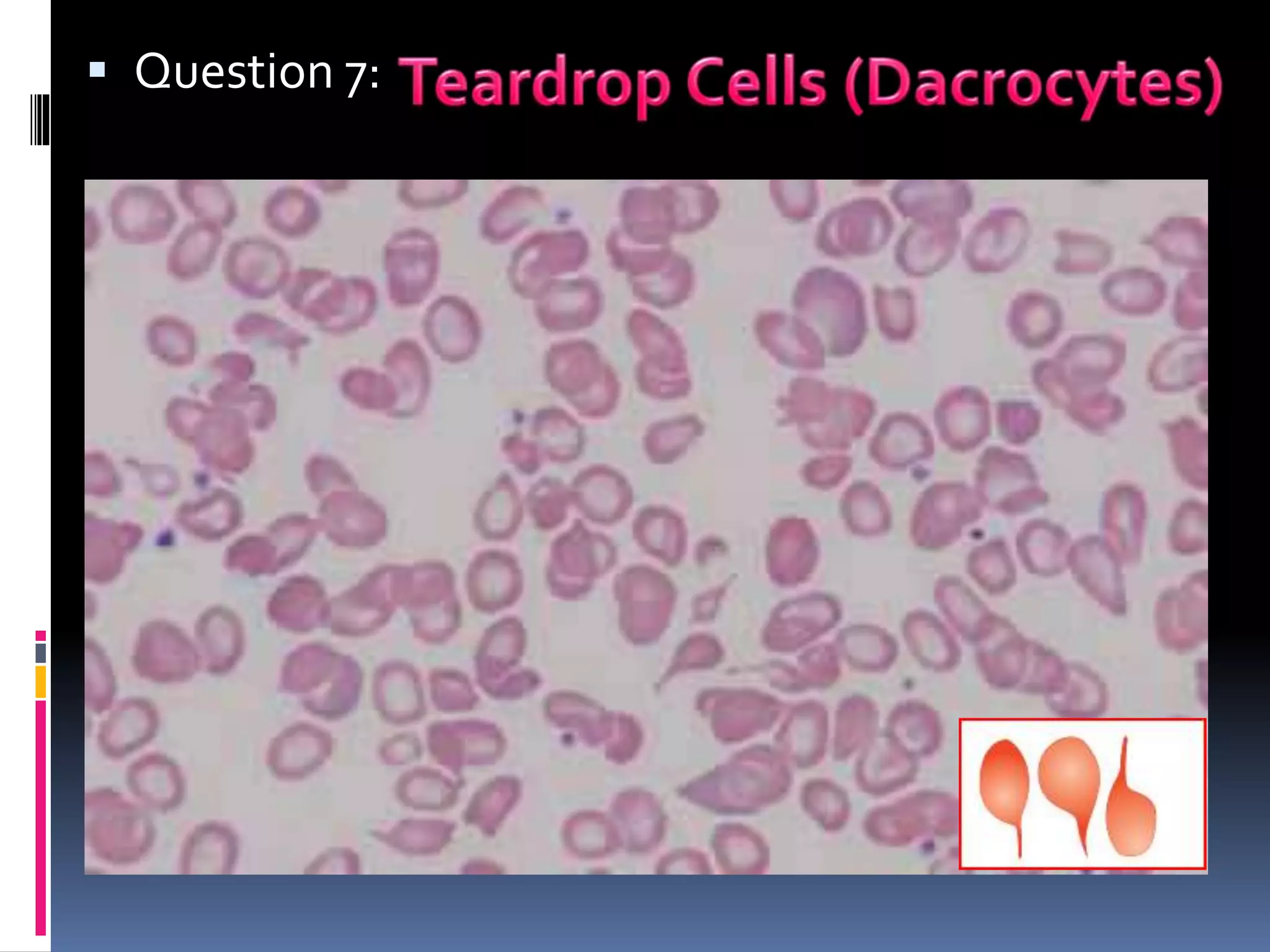 Peripheral smear..RBC disorders.. Dr.Padmesh | PPTX
