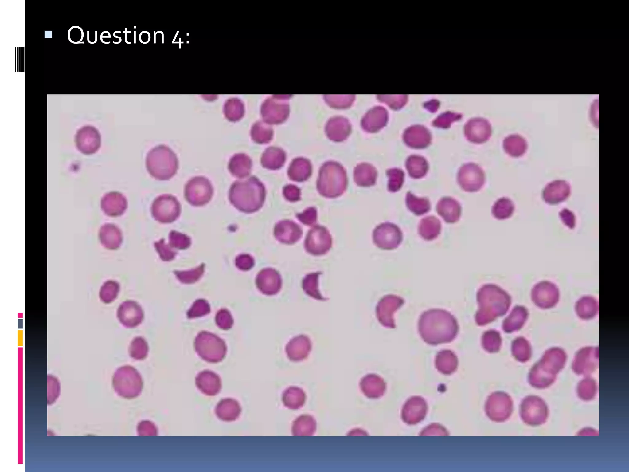 Peripheral smear..RBC disorders.. Dr.Padmesh | PPTX