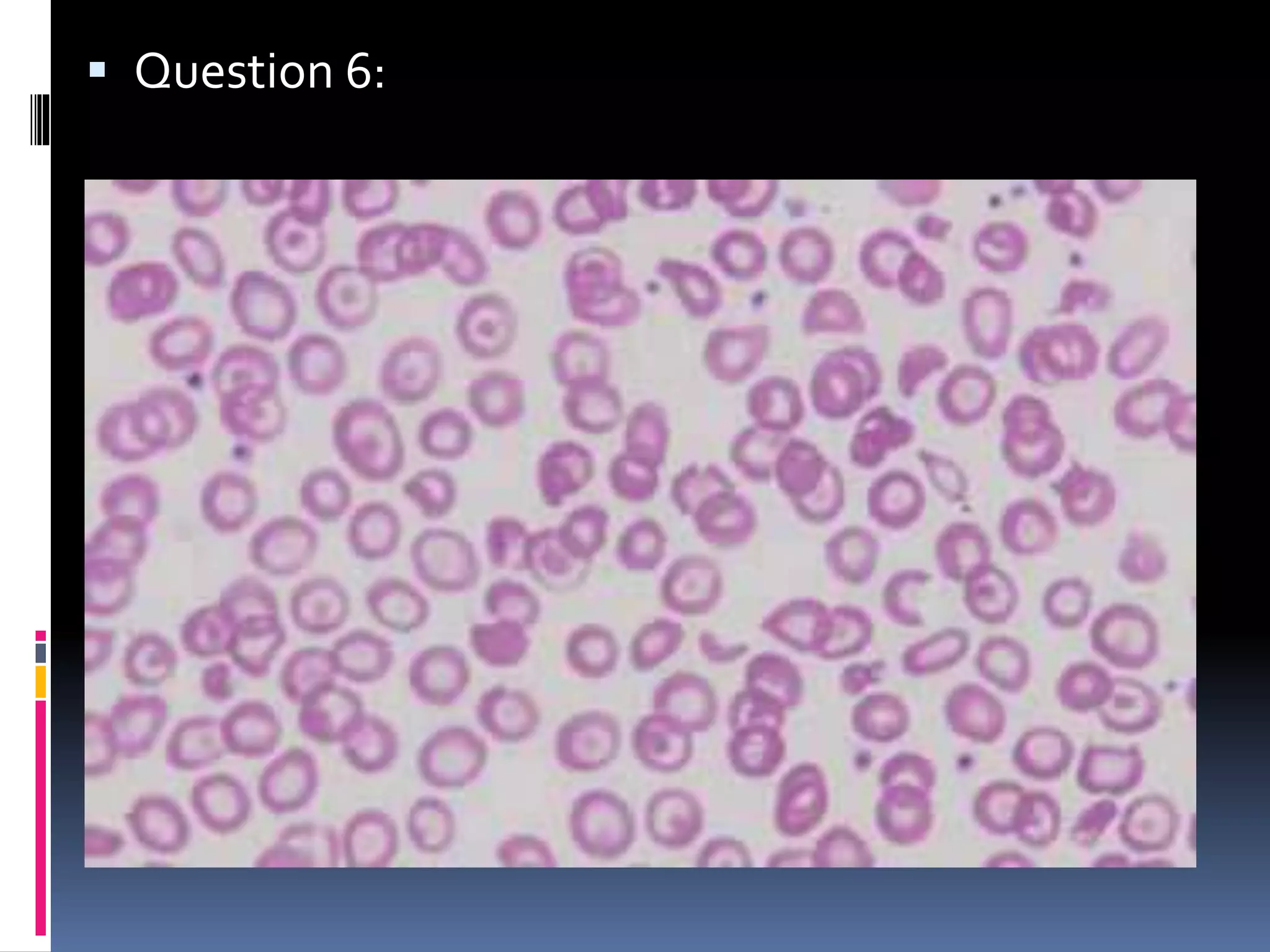 Peripheral smear..RBC disorders.. Dr.Padmesh | PPTX