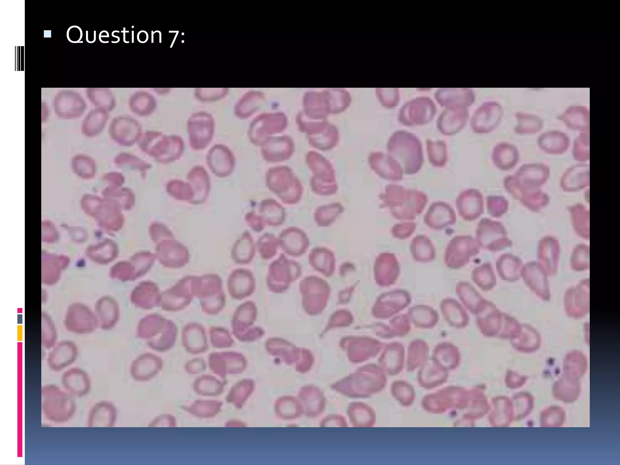 Peripheral smear..RBC disorders.. Dr.Padmesh | PPTX