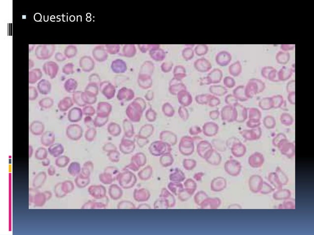Peripheral smear..RBC disorders.. Dr.Padmesh | PPT