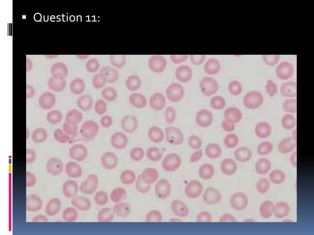 Peripheral smear..RBC disorders.. Dr.Padmesh | PPT | Free Download