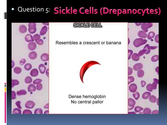 Peripheral smear..RBC disorders.. Dr.Padmesh | PPT