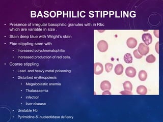 Lead Poisoning Smear