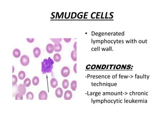 Smudge Cells In Csf