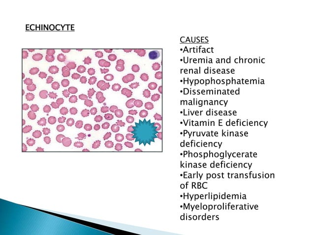 Peripheral Smear technique and reporting | PPTX | Blood Disorders ...