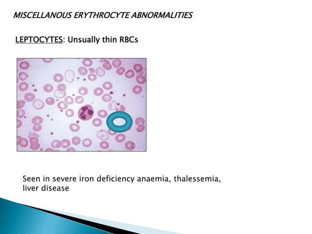 Peripheral Smear technique and reporting | PPTX | Blood Disorders ...