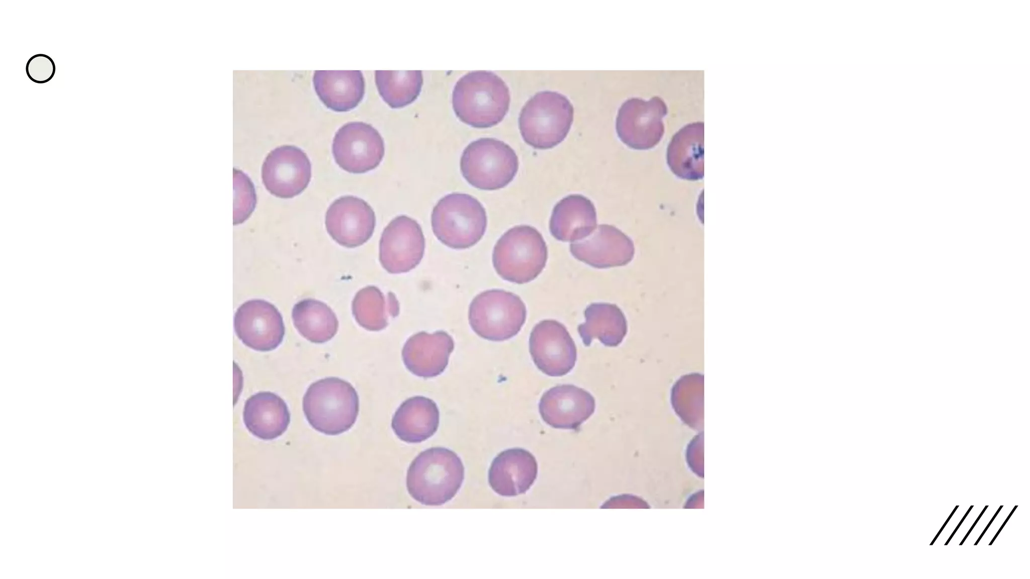 Peripheral smear staining and morphology | PDF