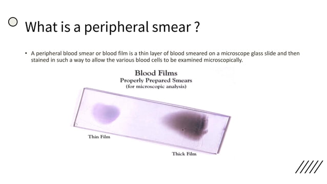 Peripheral smear staining and morphology | PDF | Blood Disorders ...