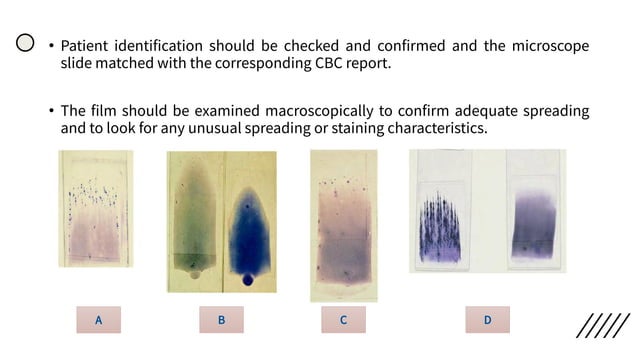 Peripheral smear staining and morphology | PDF | Blood Disorders ...