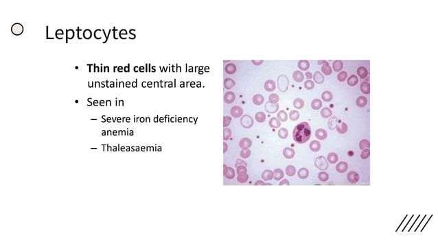 Peripheral smear staining and morphology | PDF | Blood Disorders ...