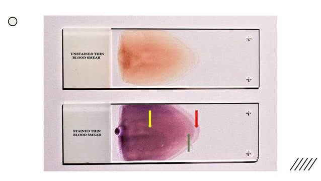 Peripheral smear staining and morphology | PDF | Blood Disorders ...