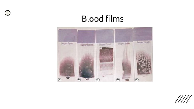 Peripheral smear staining and morphology