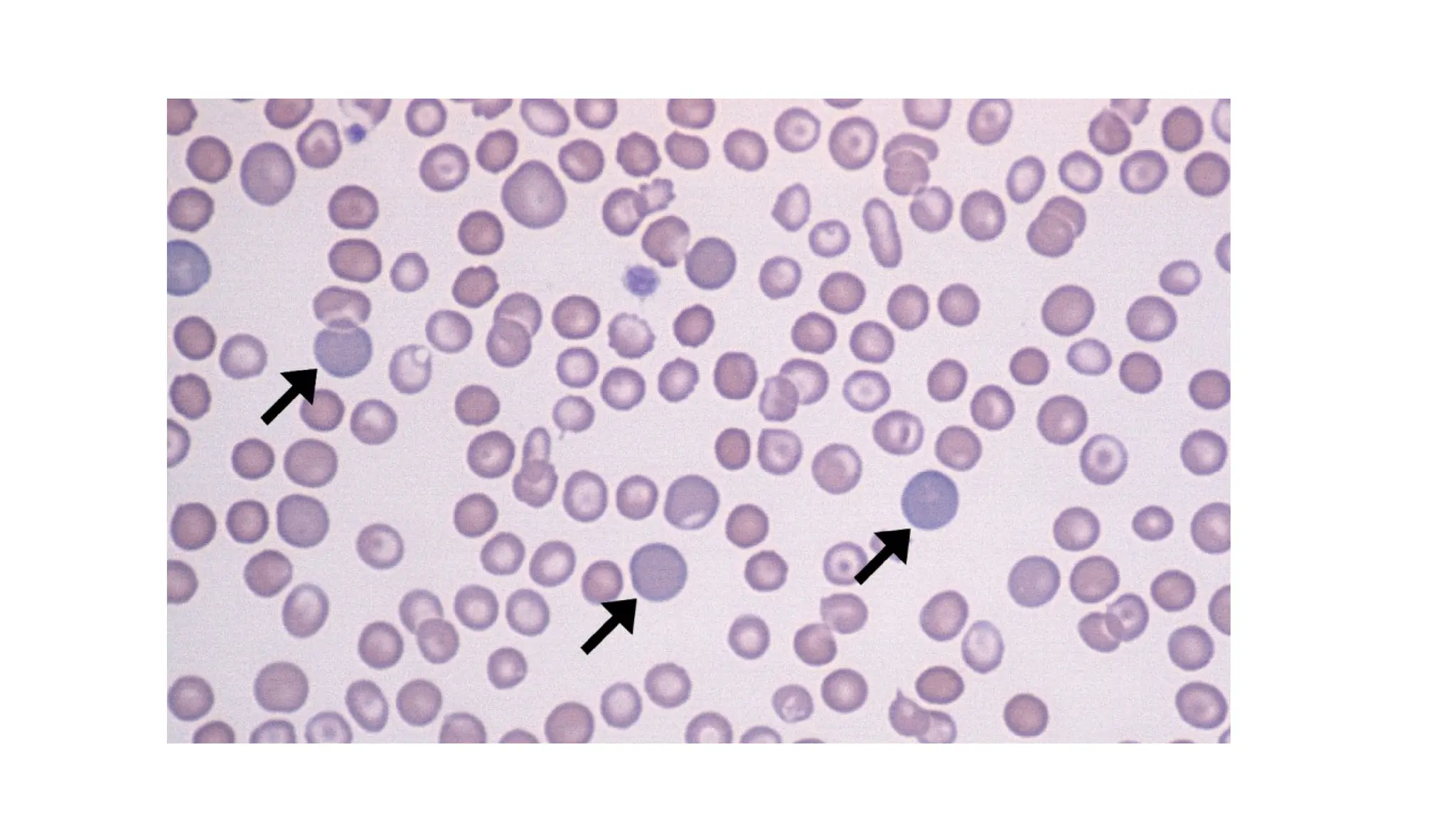 PERIPHERAL SMEAR AND RETICULOCYTE pathology.pptx