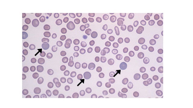 PERIPHERAL SMEAR AND RETICULOCYTE pathology.pptx