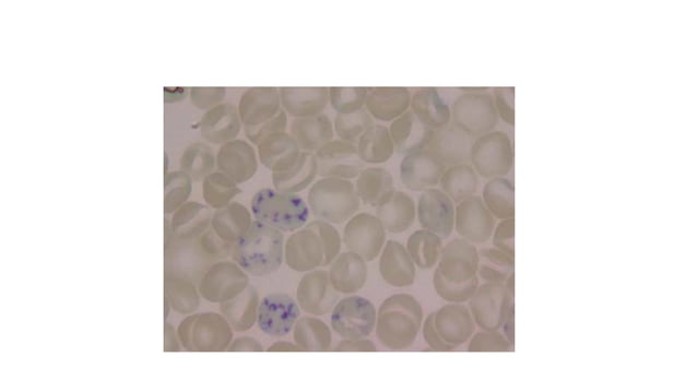 PERIPHERAL SMEAR AND RETICULOCYTE pathology.pptx