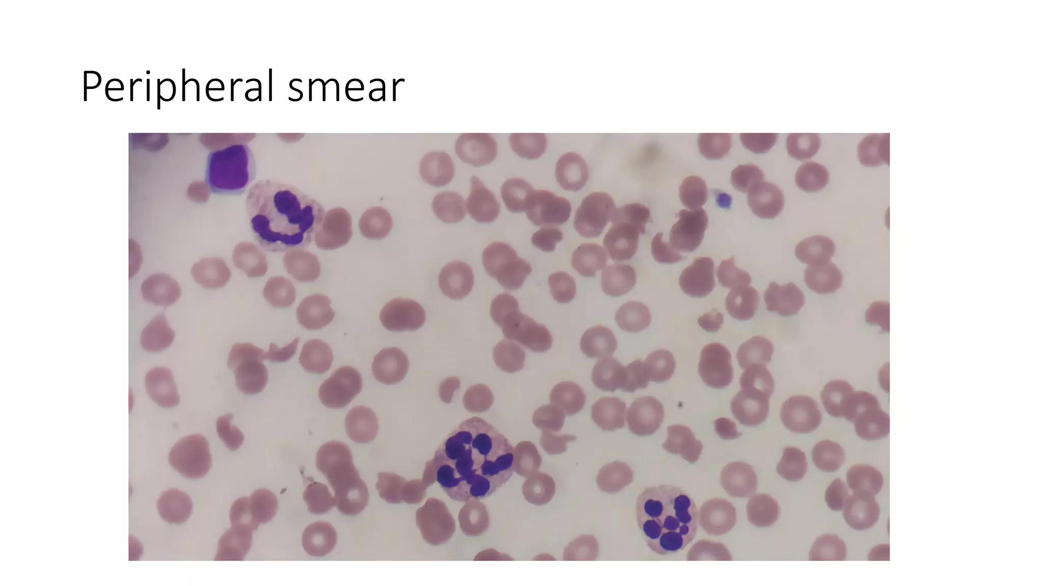 peripheral smear anemea clues.pdf