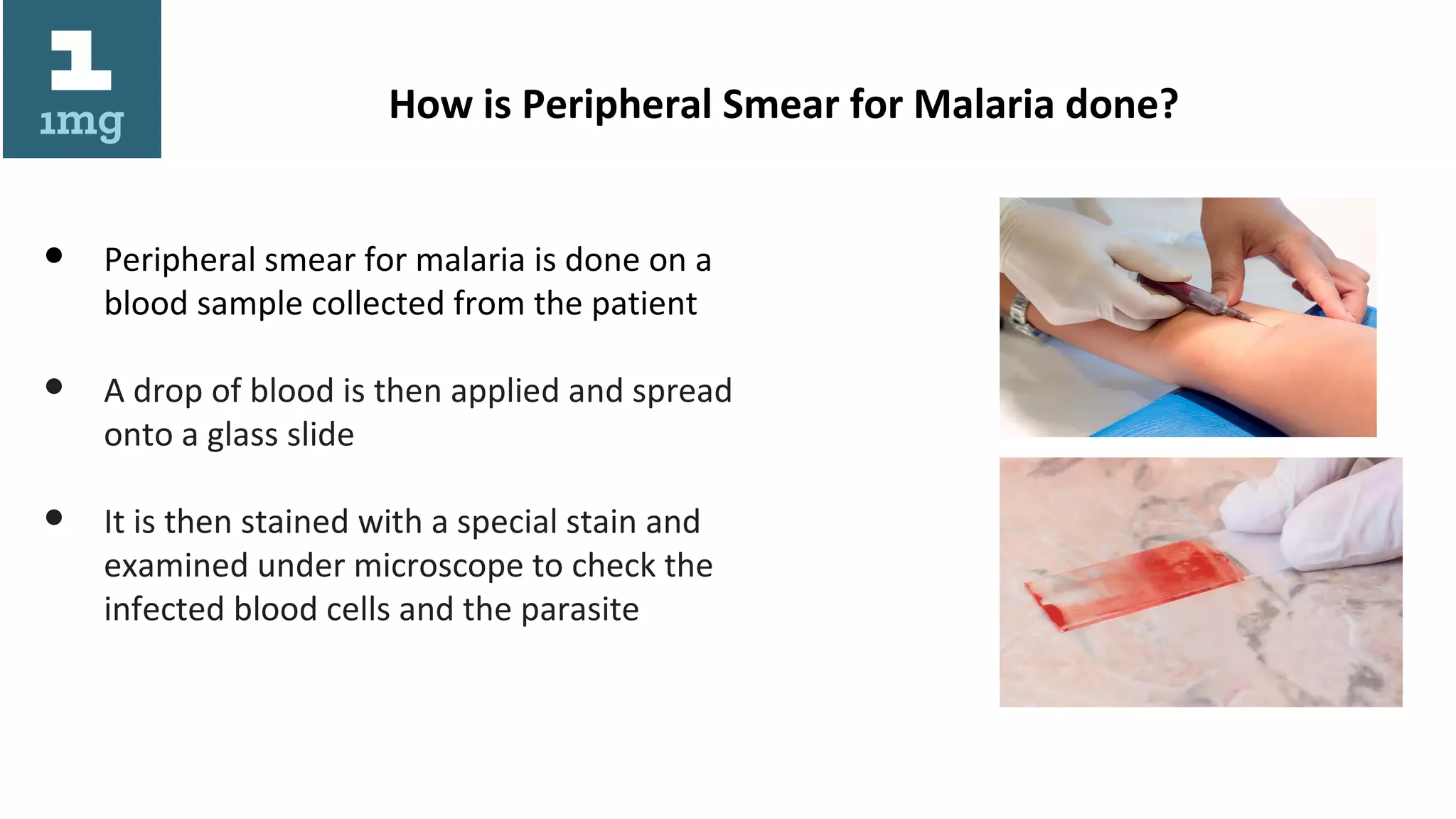 Peripheral smear for malaria | ODP