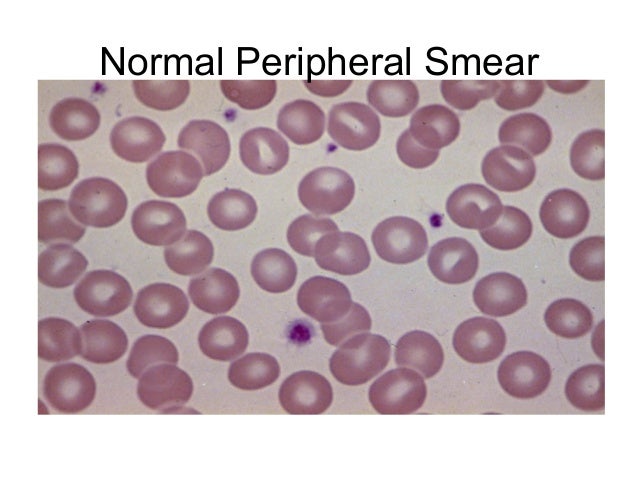 Peripheral smear