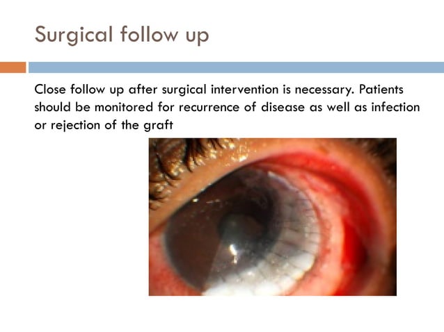 Peripheral Ulcerative Keratitis ( PUK ) | PDF | Eye and Vision ...