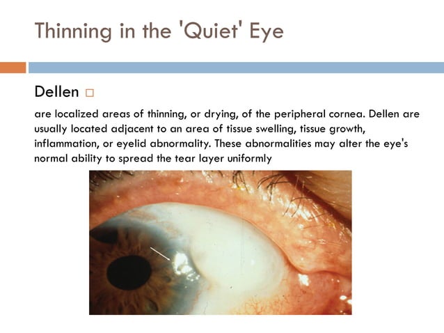 Peripheral Ulcerative Keratitis ( PUK ) | PDF | Eye and Vision ...