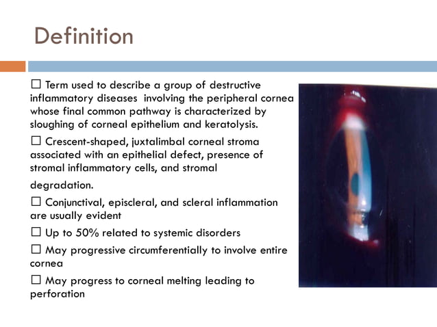 Peripheral Ulcerative Keratitis ( PUK ) | PDF | Eye and Vision ...