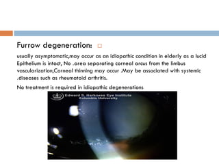 Peripheral Ulcerative Keratitis ( PUK ) | PDF