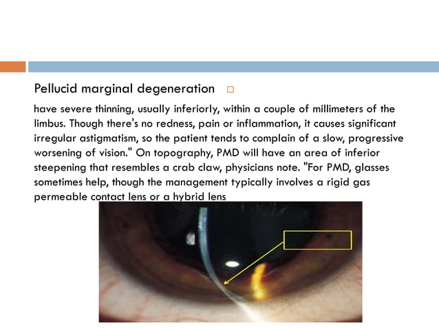 Peripheral Ulcerative Keratitis ( PUK ) | PDF | Eye and Vision ...