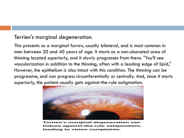 Peripheral Ulcerative Keratitis ( PUK ) | PDF | Eye and Vision ...
