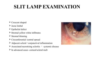 PERIPHERAL ULCERATIVE KERATITIS (1) .pptx