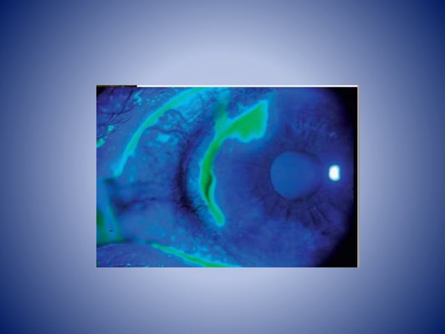 Peripheral ulcerative keratitis (puk) | PPTX