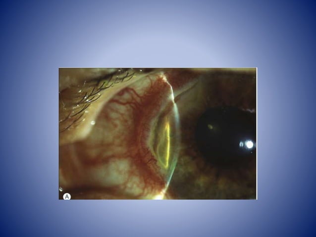Peripheral ulcerative keratitis (puk) | PPTX
