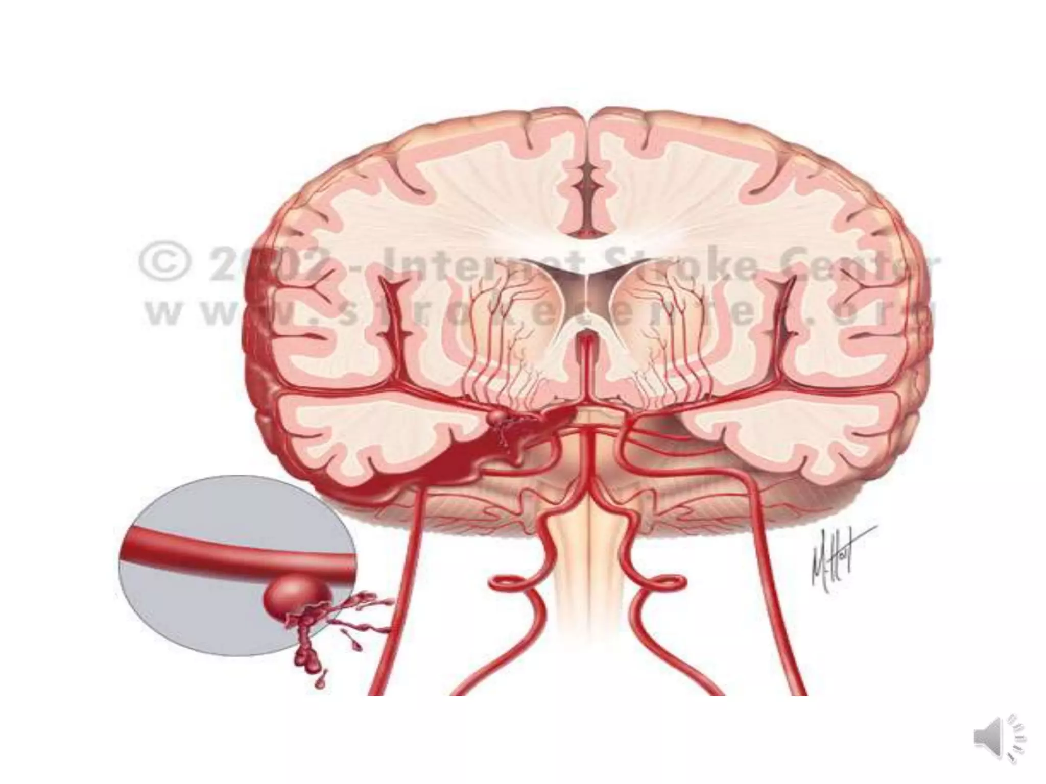 Peripheral vascular disease | PPTX