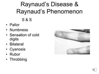 Peripheral vascular disease | PPTX