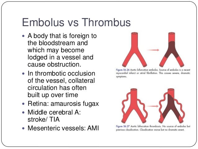 Peripheral vascular disease