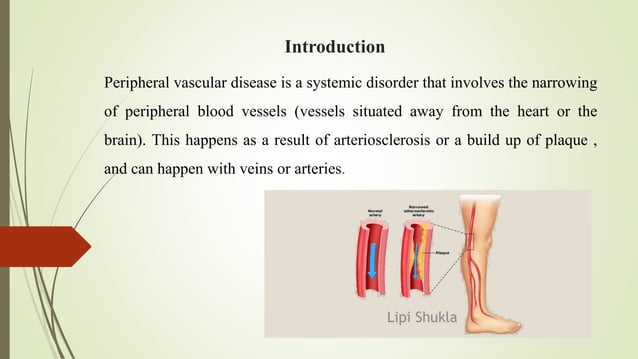 peripheral vascular disease.pptx | Foot Health | Diseases and Conditions