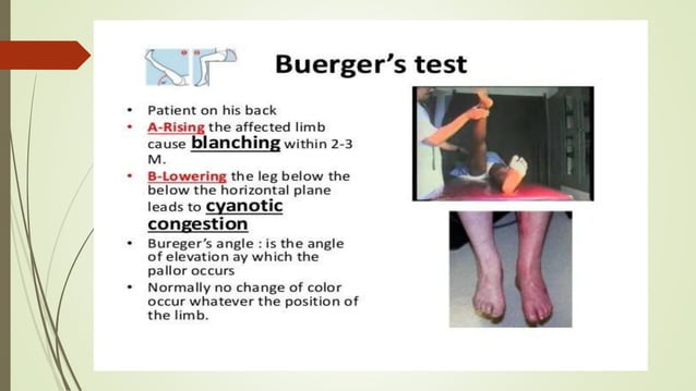 peripheral vascular disease.pptx | Foot Health | Diseases and Conditions