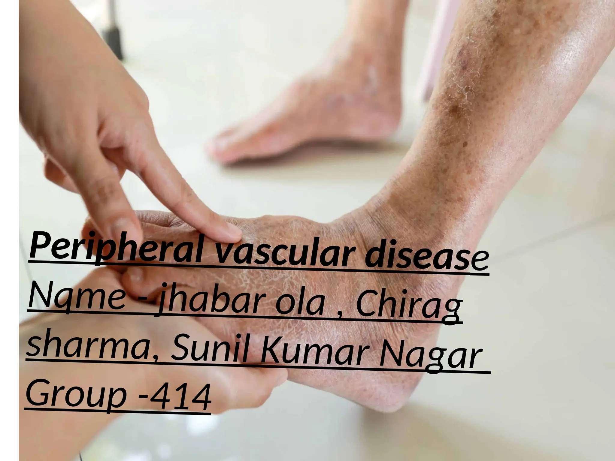 peripheral vascular disease group 414 jhabar, sunil, Chirag.pptx