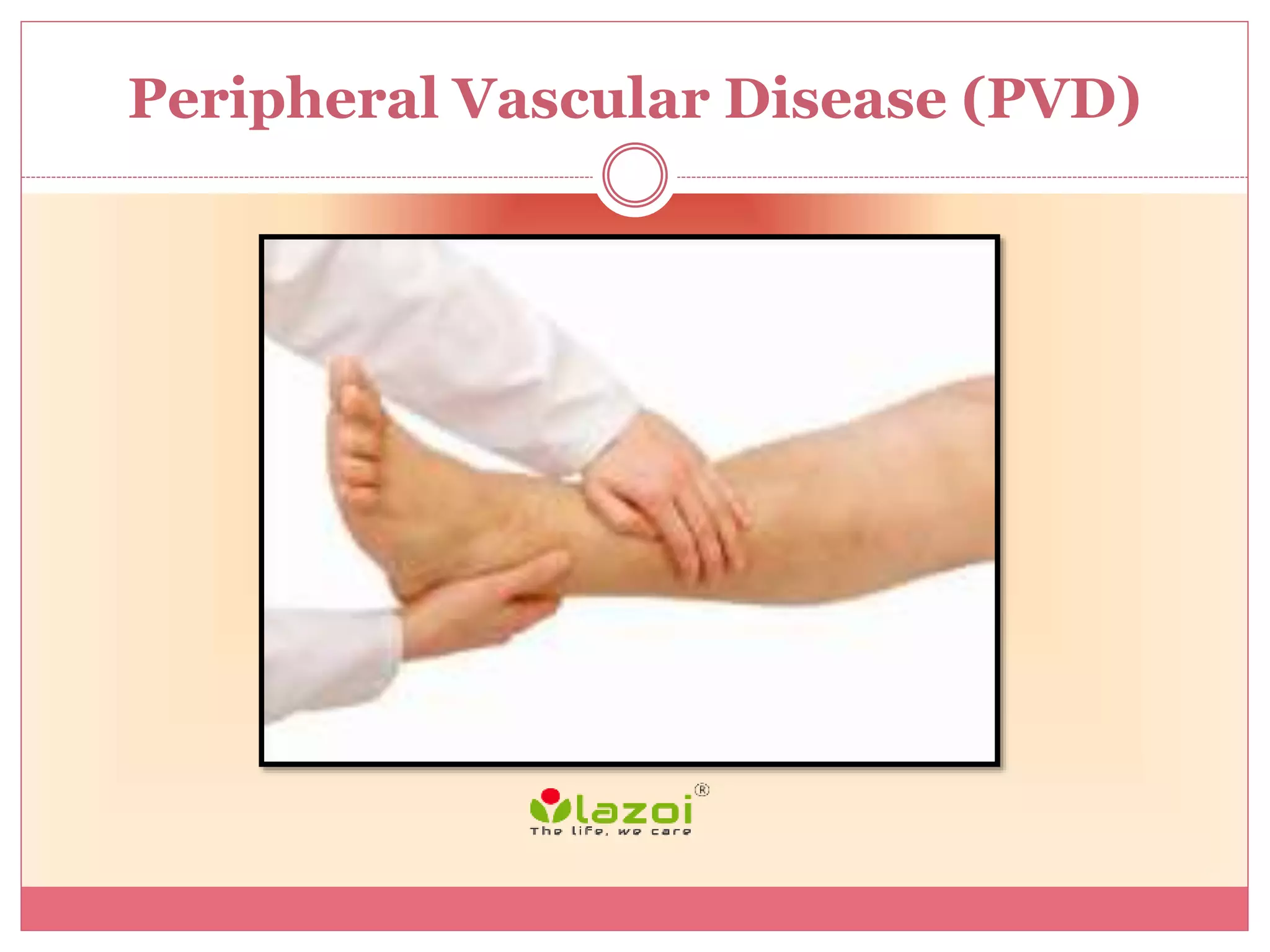 Peripheral vascular disease (pvd) | PPTX