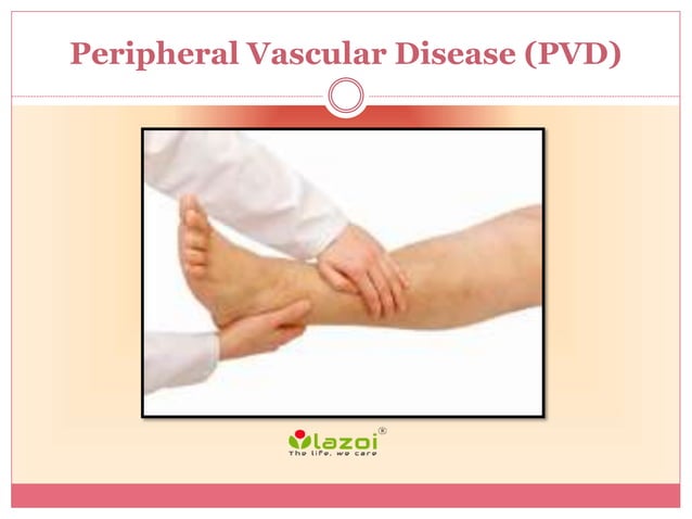 Peripheral vascular disease (pvd) | PPTX | Heart and Cardiovascular ...